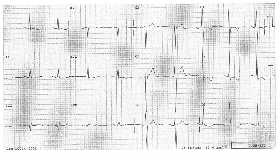 CardioTruco: cálculo eje cardíaco - Cardioprimaria Ferrol