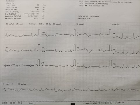 Fenocopia Sd. de Brugada - Cardioprimaria Ferrol