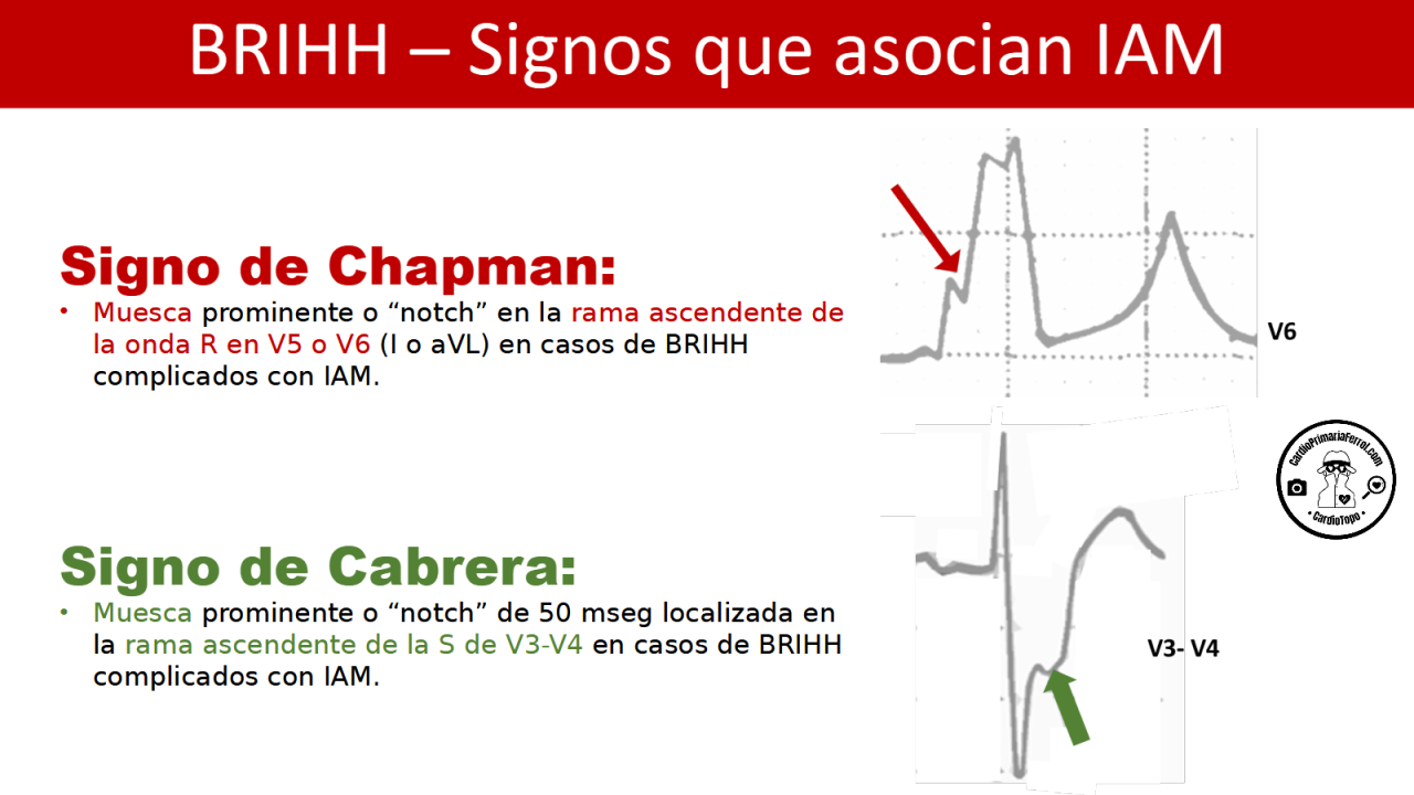 CardioTruco: signos de Chapman y Cabrera - Cardioprimaria Ferrol