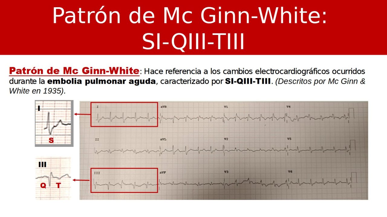 CardioTruco: Patrón de McGinn-White - Cardioprimaria Ferrol