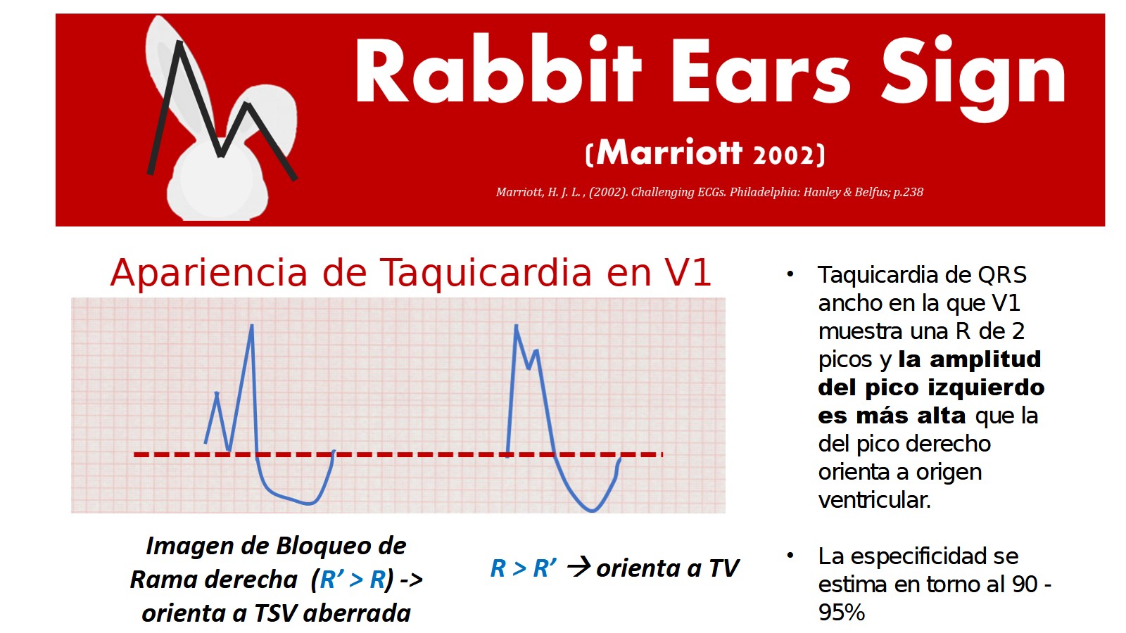 CardioTruco: Signo de Marriott - Cardioprimaria Ferrol