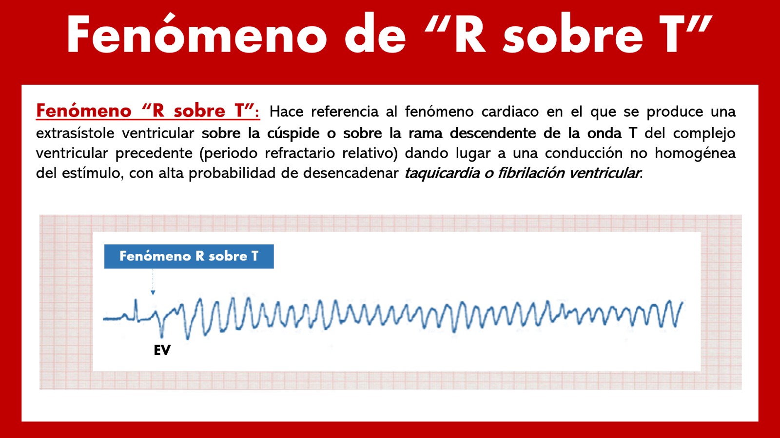 CardioTruco: Fenómeno R sobre T - Cardioprimaria Ferrol