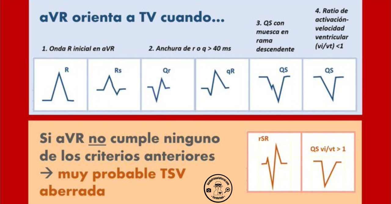 CardioTruco: algoritmo de Vereckei - Cardioprimaria Ferrol