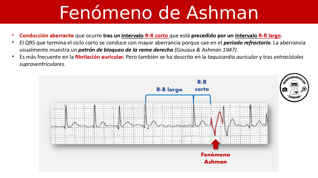 CardioTruco: Fenómeno de Ashman - Cardioprimaria Ferrol
