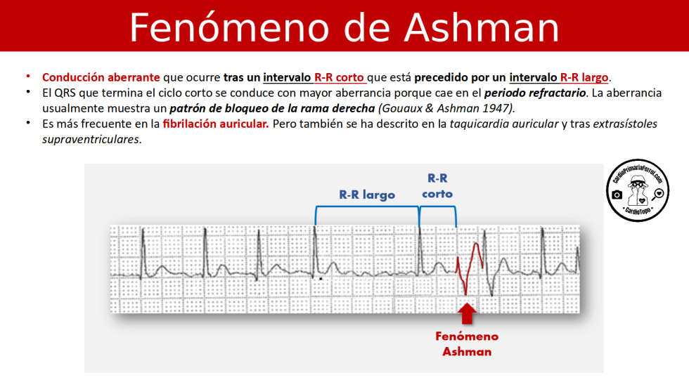 CardioTruco: Fenómeno de Ashman - Cardioprimaria Ferrol